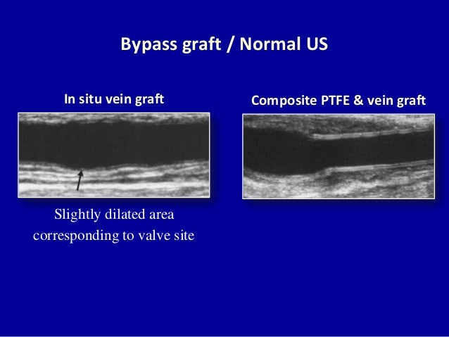 Doppler ultrasound of lower limb arteries