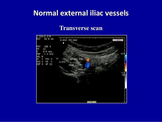 External Iliac Artery