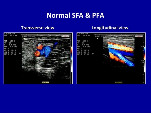 Doppler ultrasound of lower limb arteries