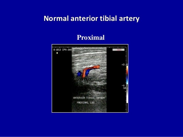 Doppler ultrasound of lower limb arteries