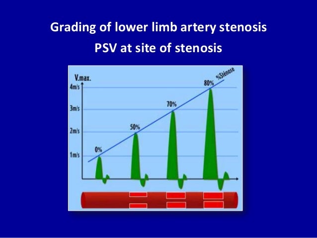 Doppler ultrasound of lower limb arteries