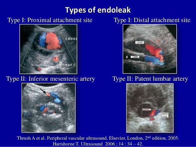Doppler ultrasound of lower limb arteries