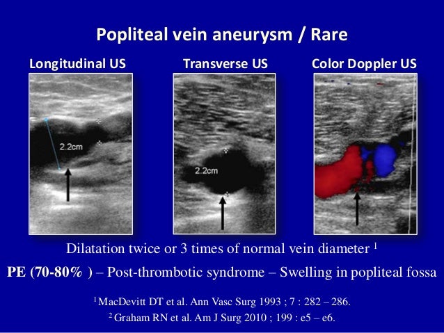 Doppler ultrasound of lower limb arteries