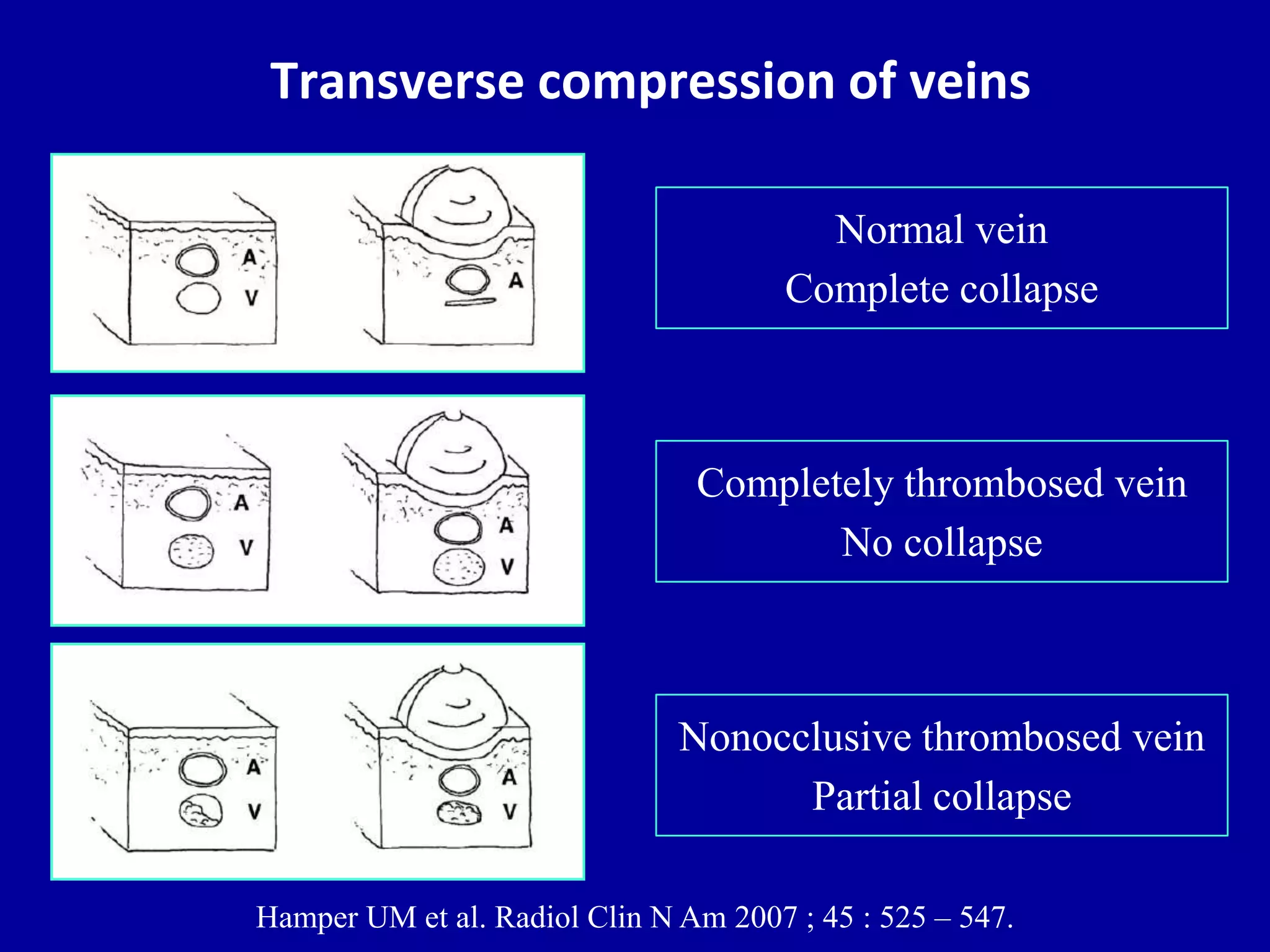 Doppler ultrasound of normal venous flow | PPTX
