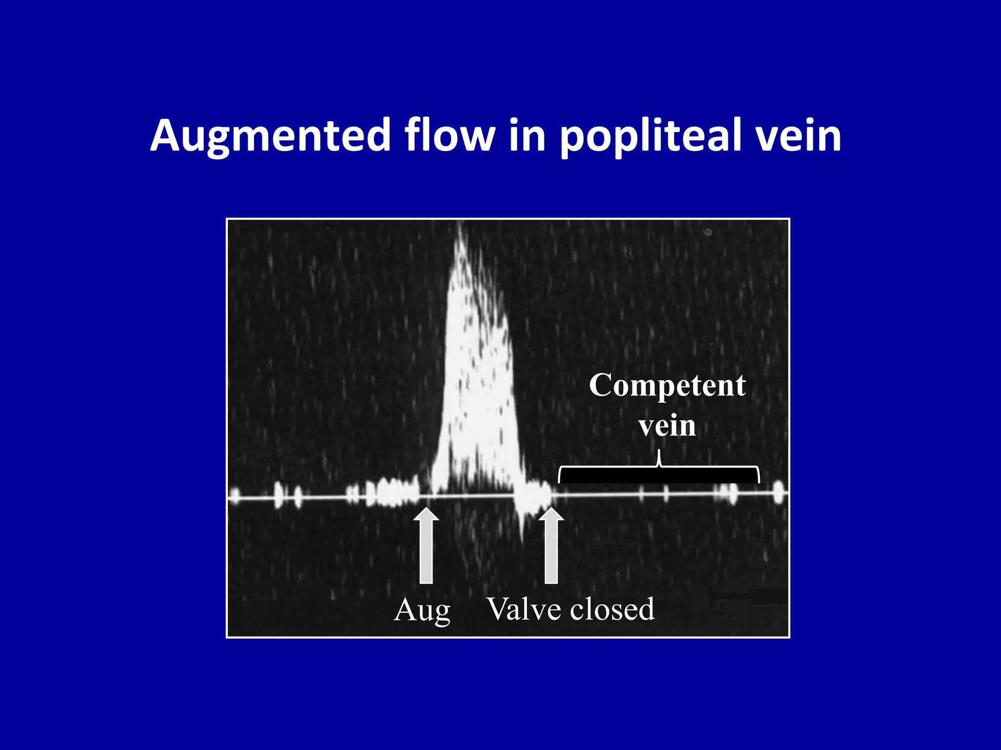 Popliteal Vein Valve Ultrasound