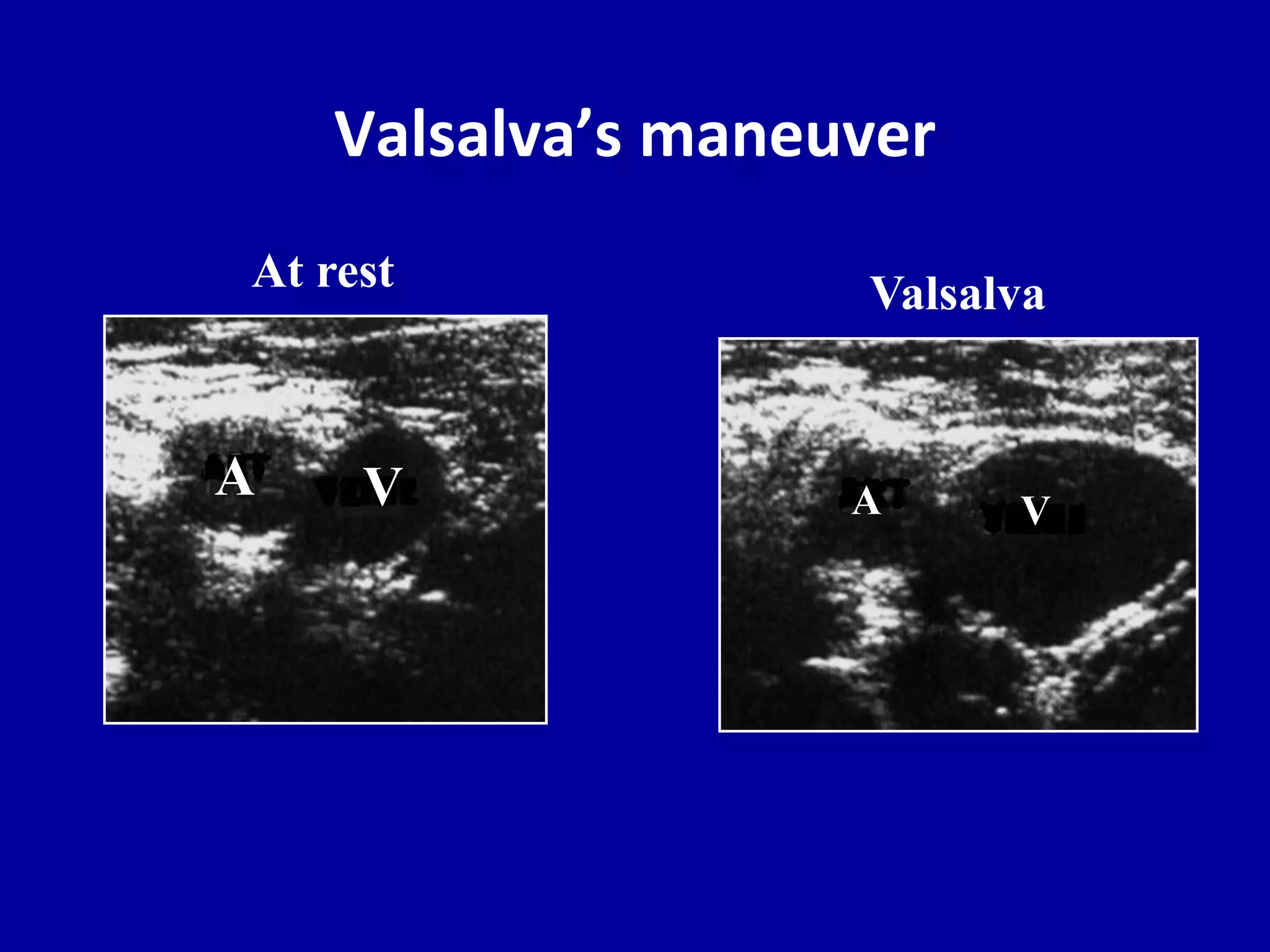 Doppler ultrasound of normal venous flow | PPTX