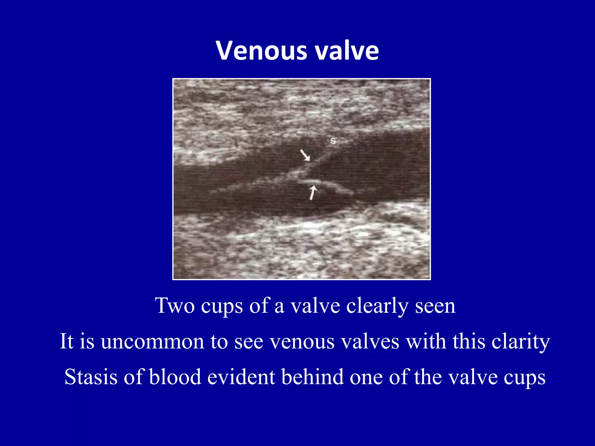Doppler ultrasound of normal venous flow | PPTX