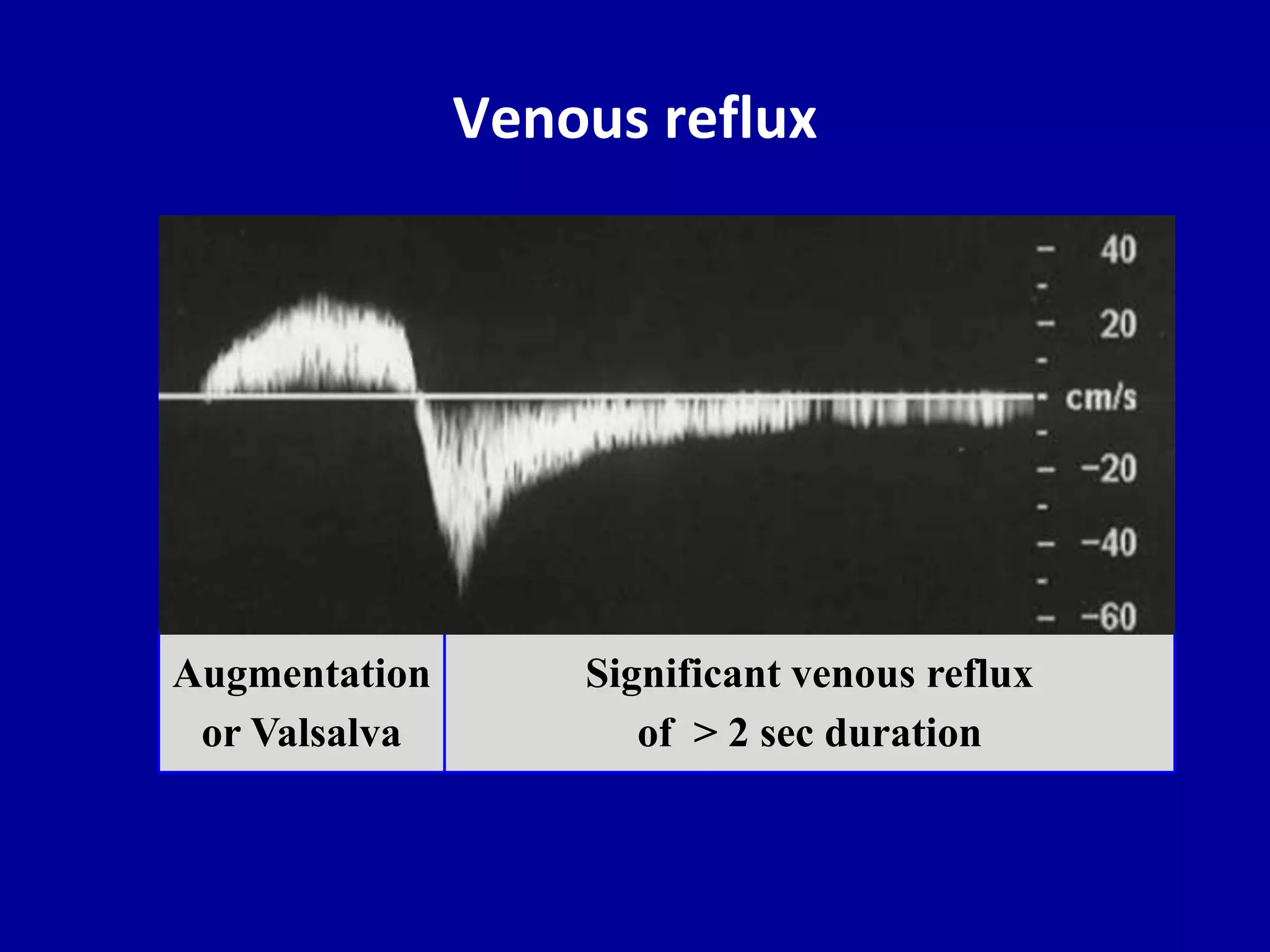 Doppler ultrasound of normal venous flow | PPTX