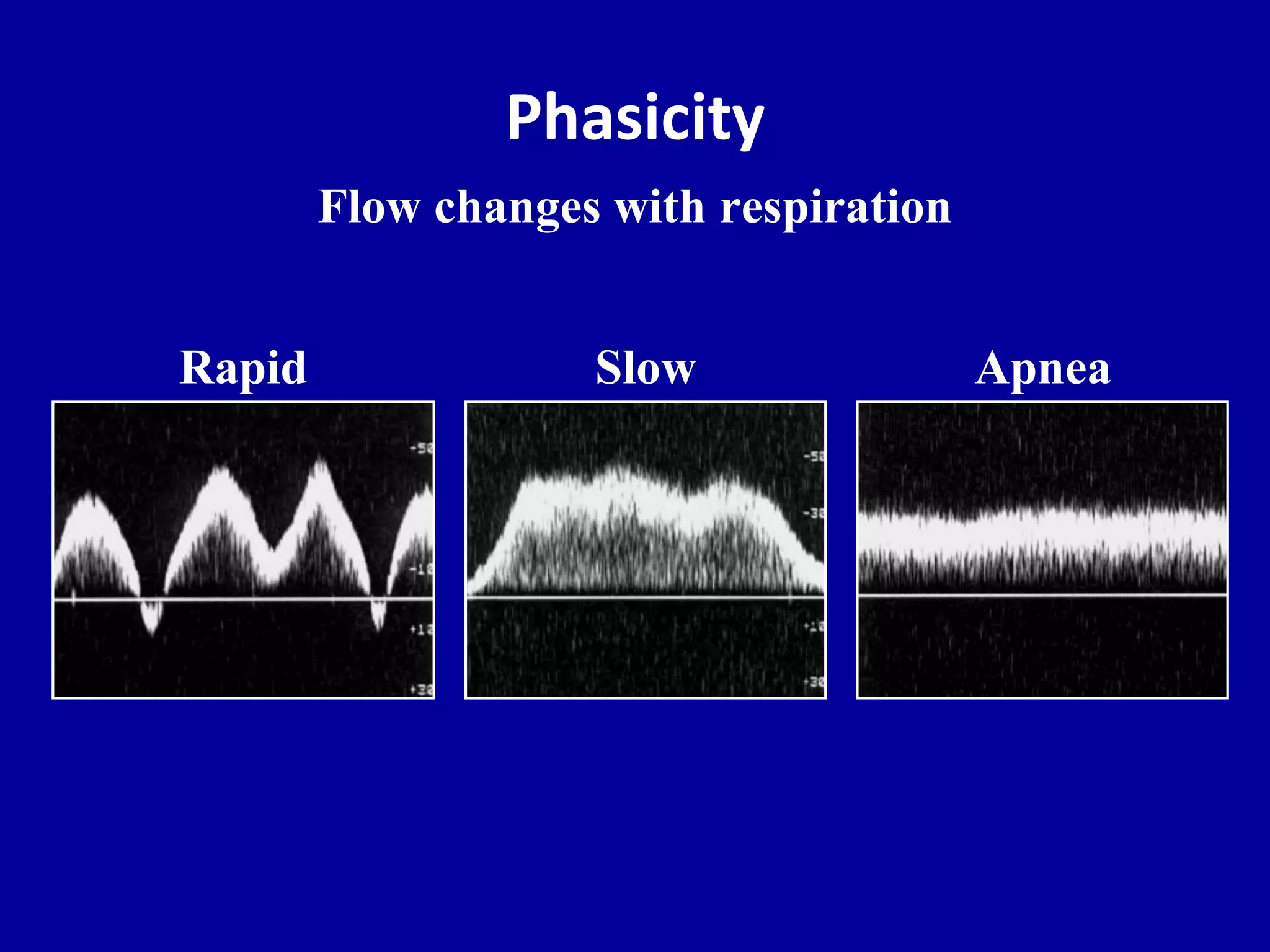Doppler ultrasound of normal venous flow | PPTX