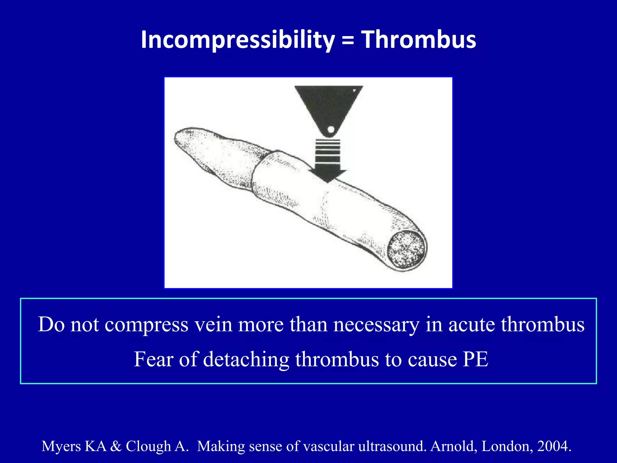 Doppler ultrasound of normal venous flow | PPTX