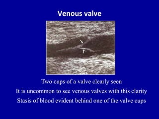 Doppler ultrasound of normal venous flow | PPTX