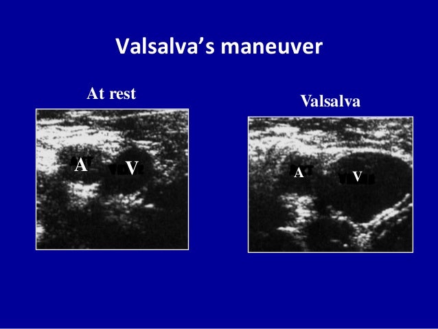 Doppler ultrasound of normal venous flow