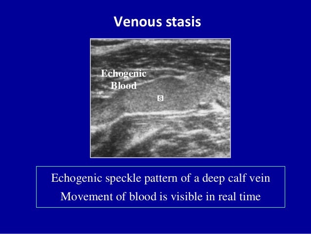 Doppler ultrasound of normal venous flow