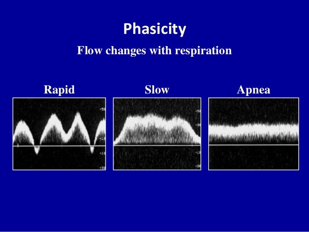 Doppler ultrasound of normal venous flow
