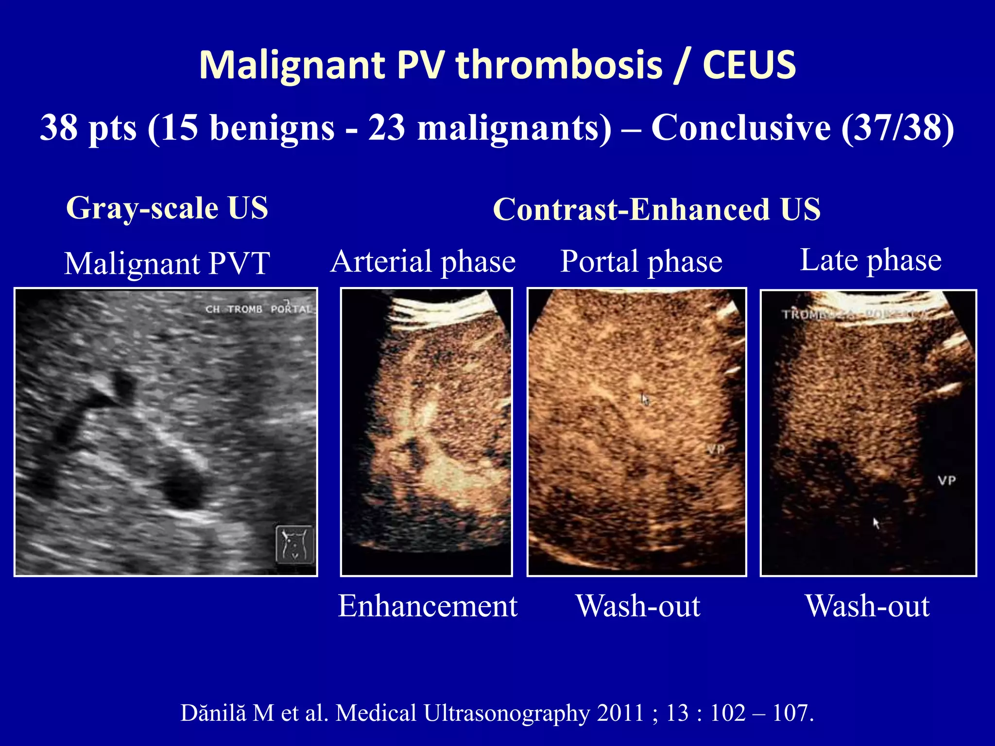 Doppler ultrasound of portal vein thrombosis | PPTX
