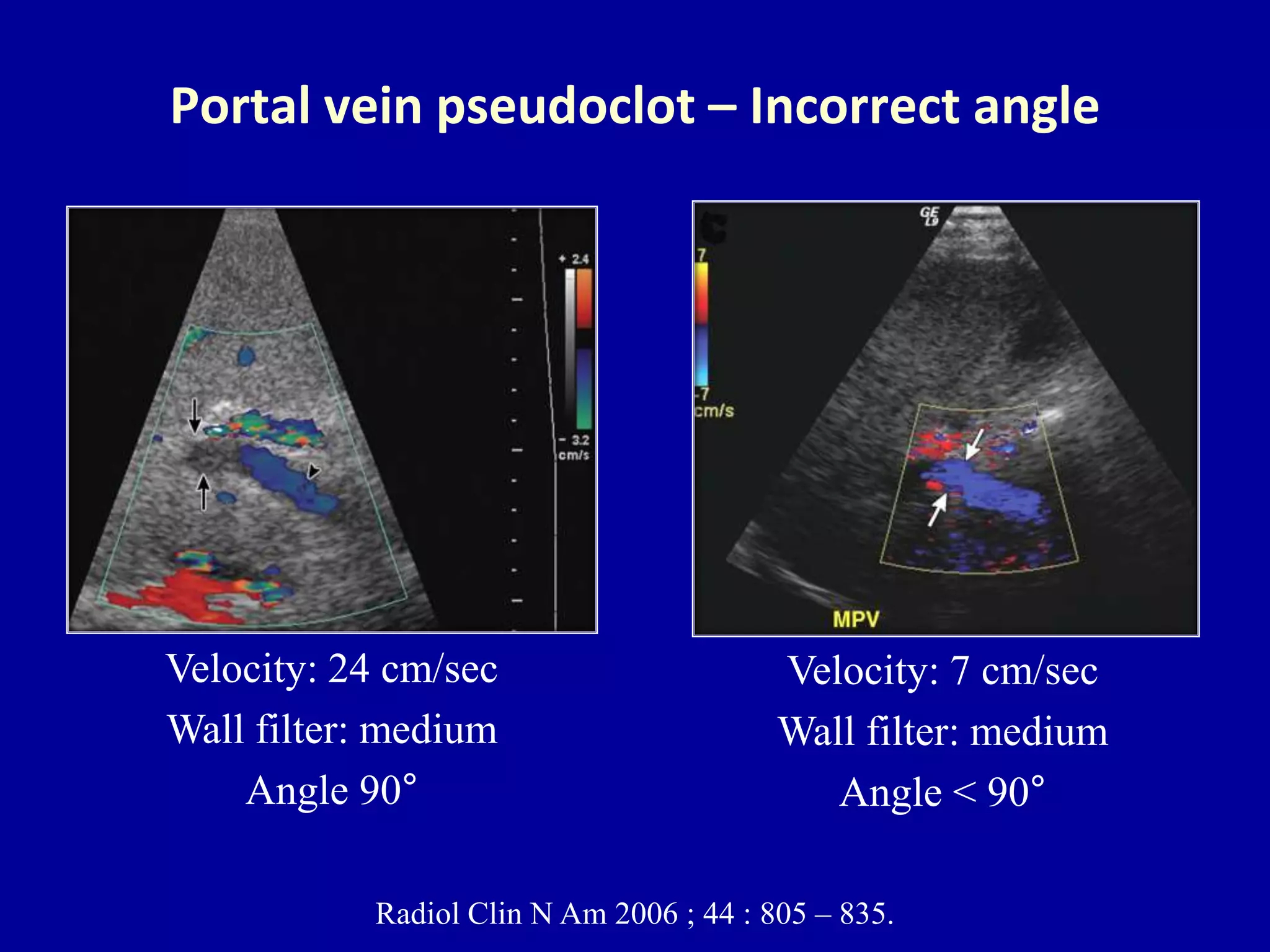 Doppler ultrasound of portal vein thrombosis | PPTX