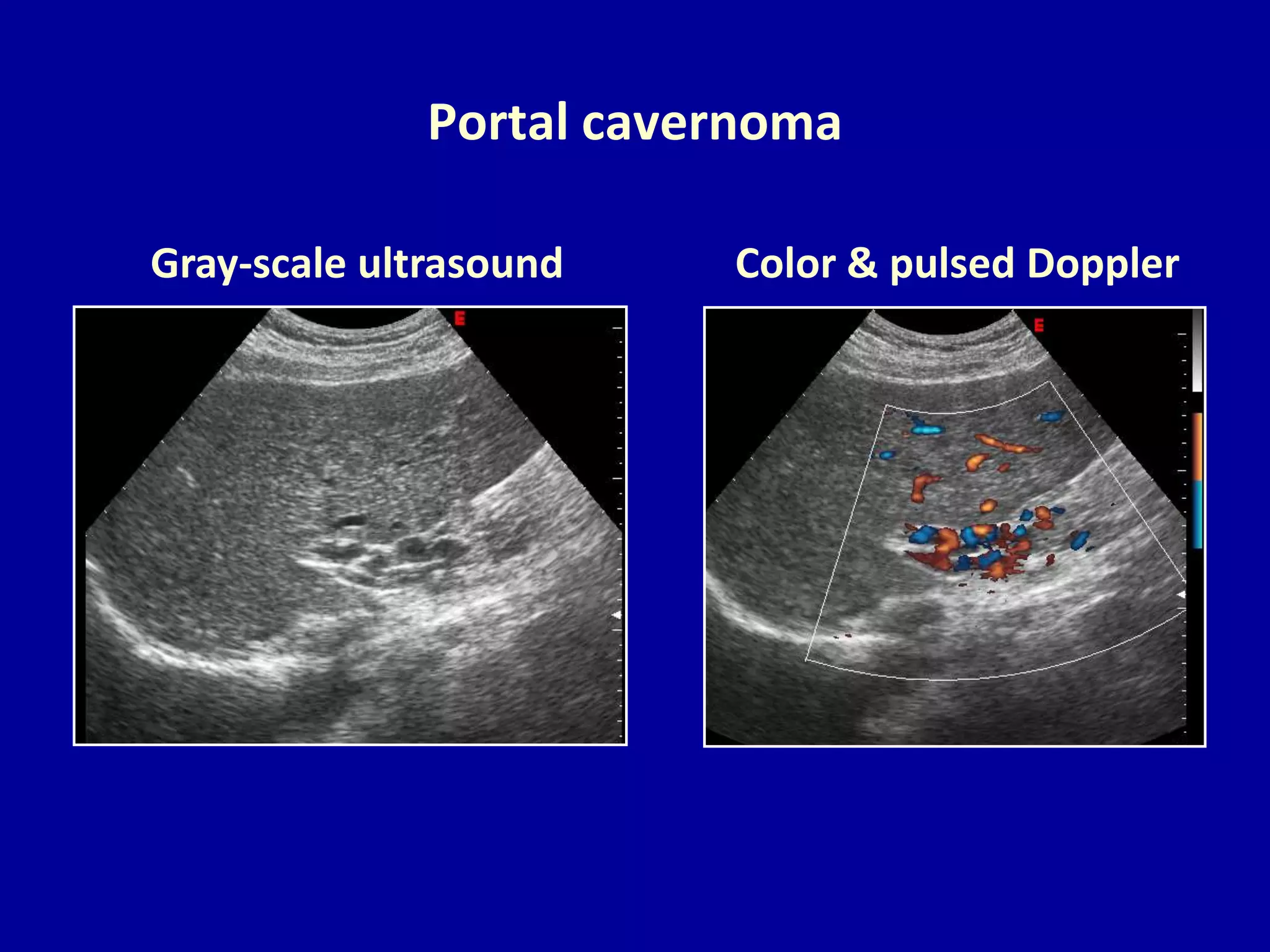 Doppler ultrasound of portal vein thrombosis | PPTX