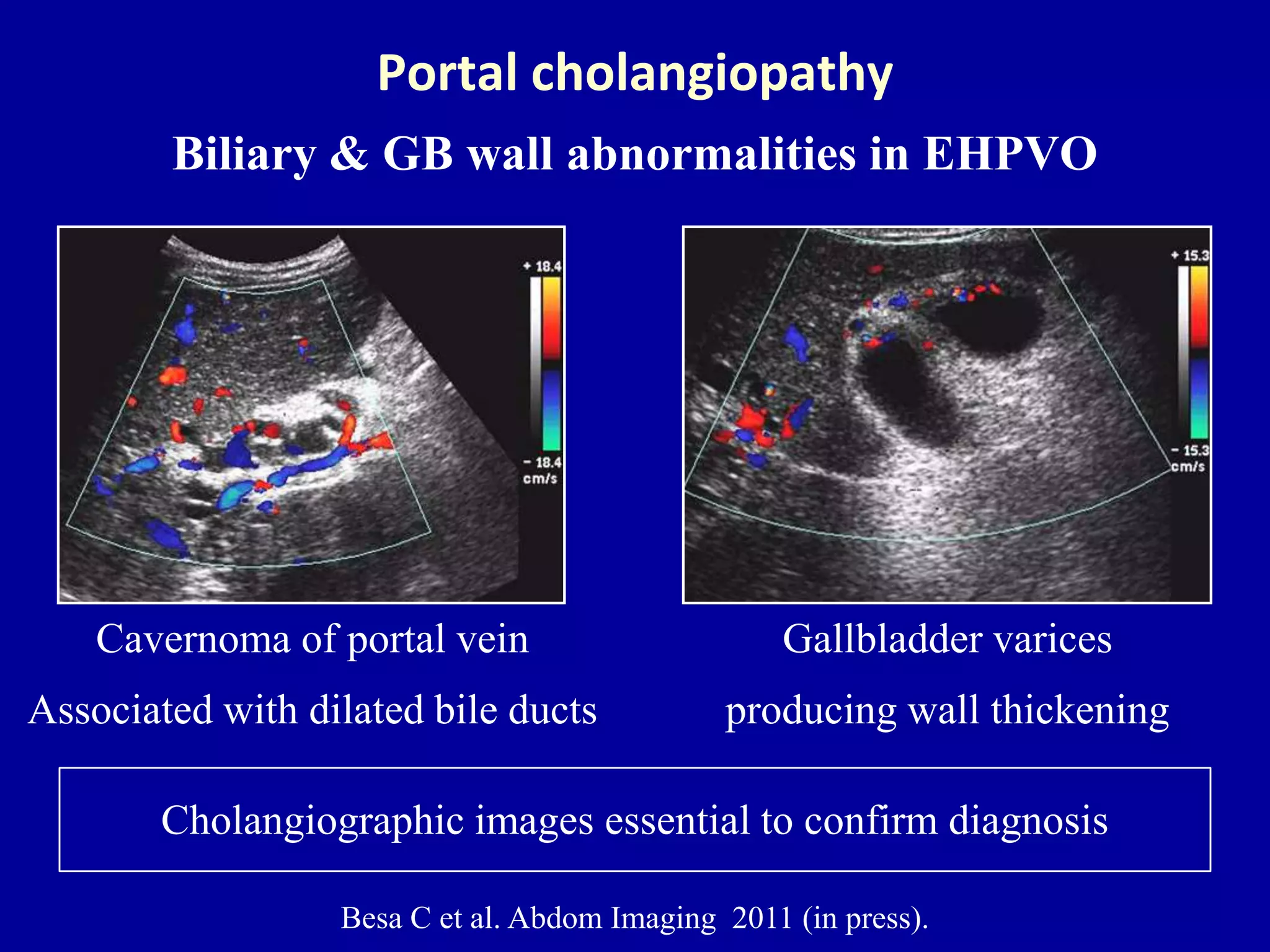 Doppler ultrasound of portal vein thrombosis | PPTX