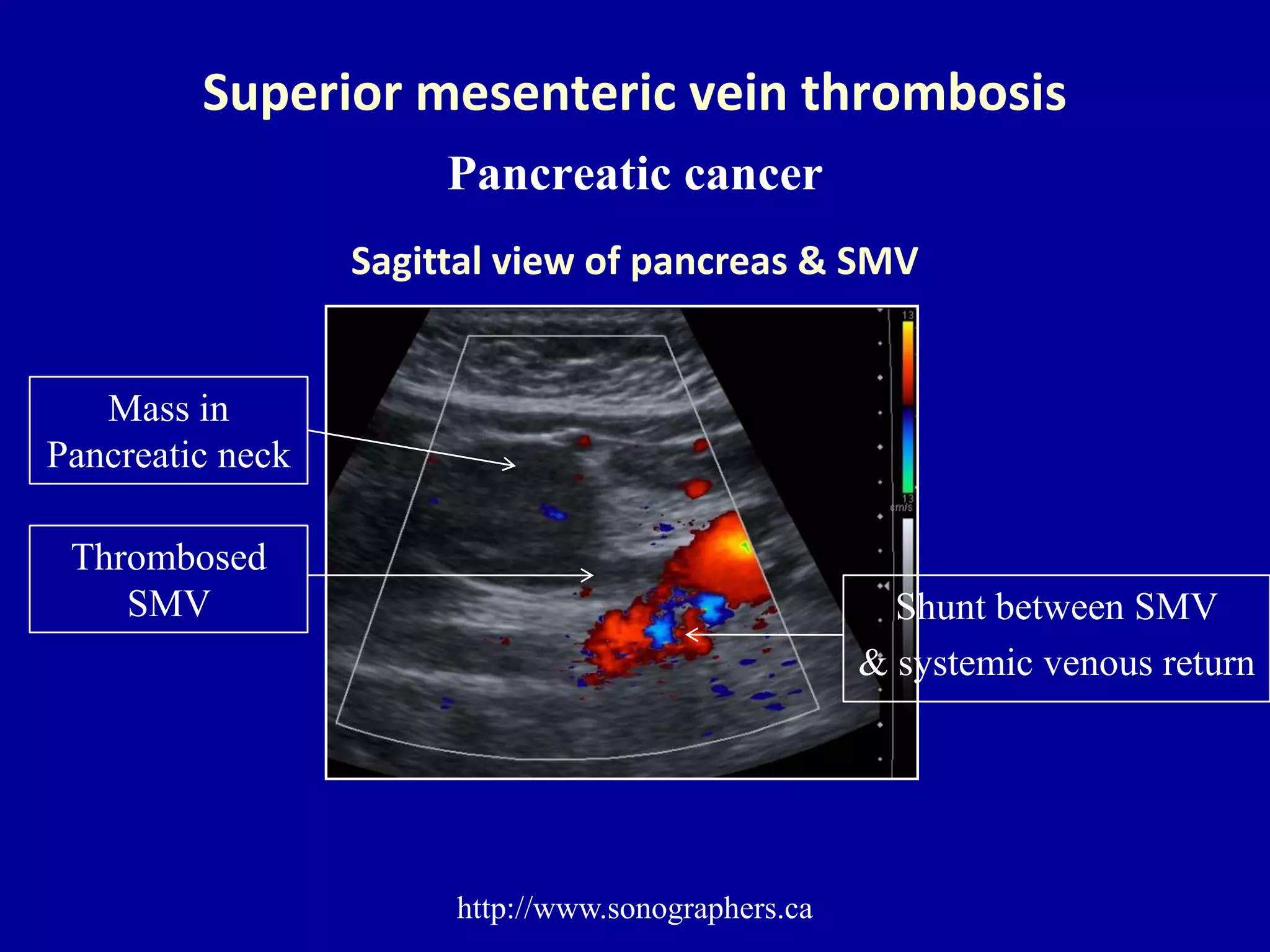 Doppler ultrasound of portal vein thrombosis | PPTX