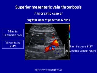 Superior Mesenteric Vein Thrombosis Ultrasound