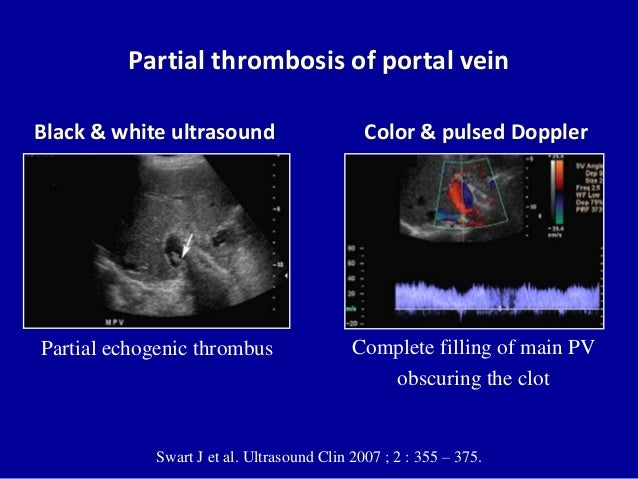 Doppler ultrasound of portal vein thrombosis