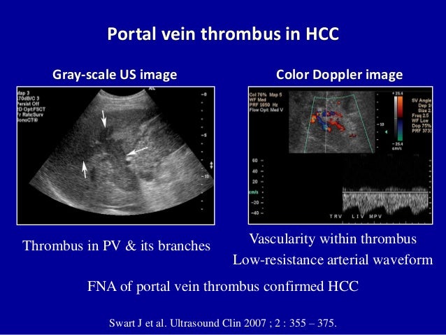 Doppler ultrasound of portal vein thrombosis