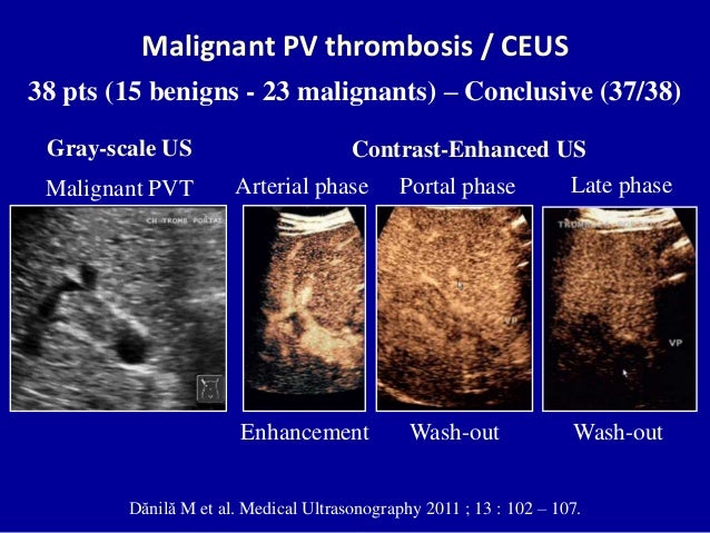 Doppler ultrasound of portal vein thrombosis
