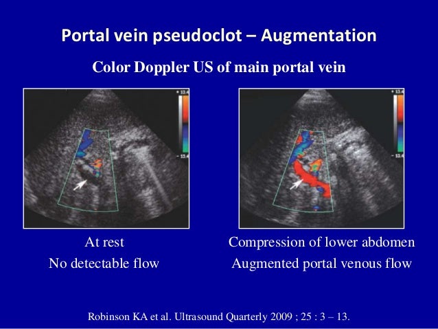 Doppler ultrasound of portal vein thrombosis