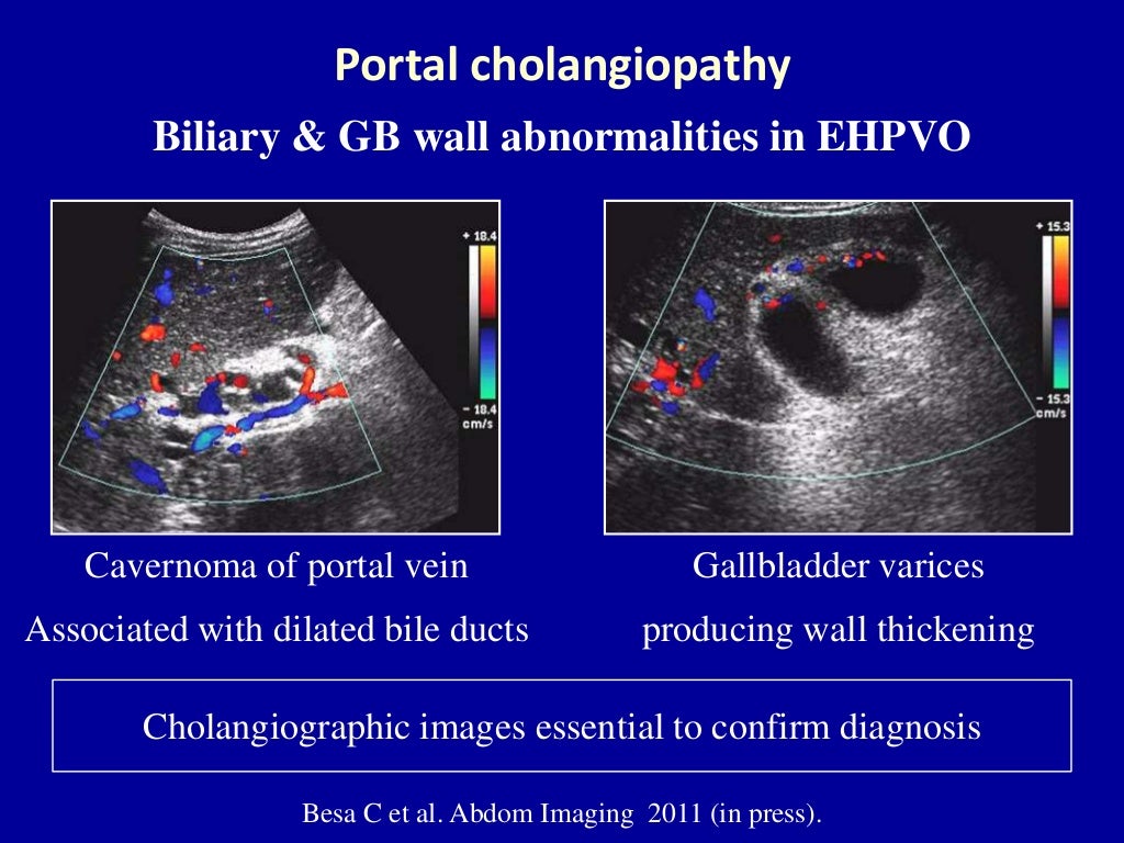 Doppler ultrasound of portal vein thrombosis