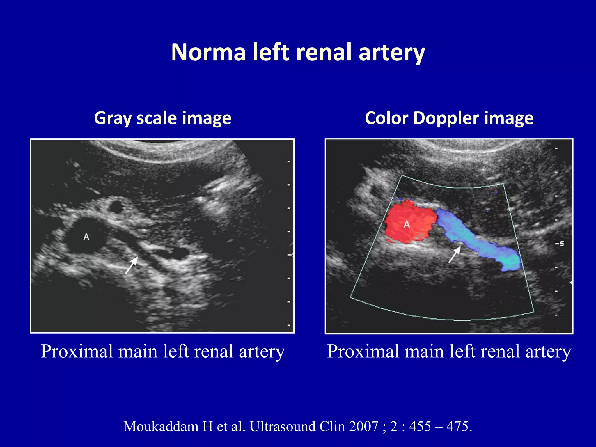 Doppler ultrasound of the kidneys | PPTX