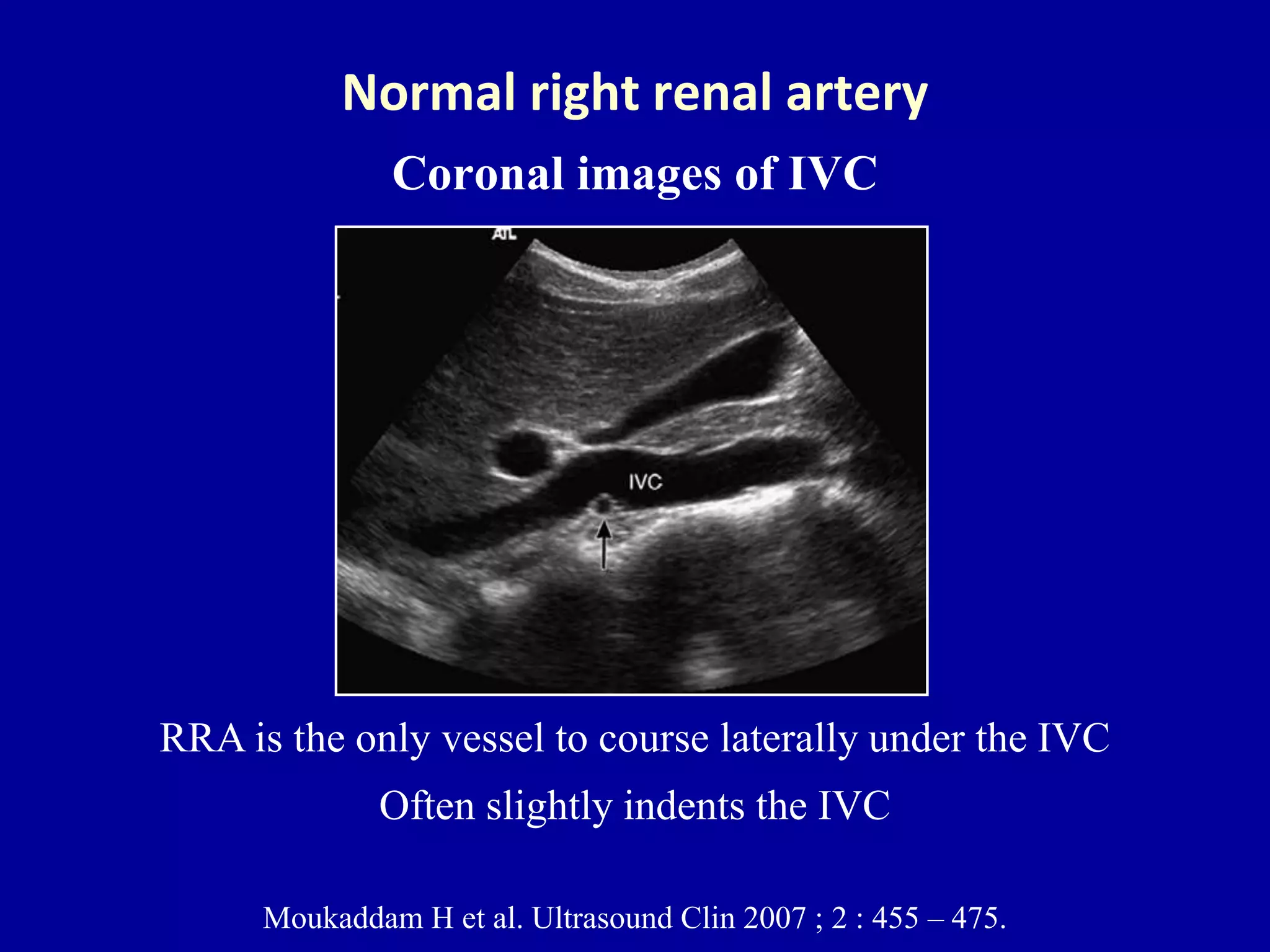 Doppler ultrasound of the kidneys | PPTX