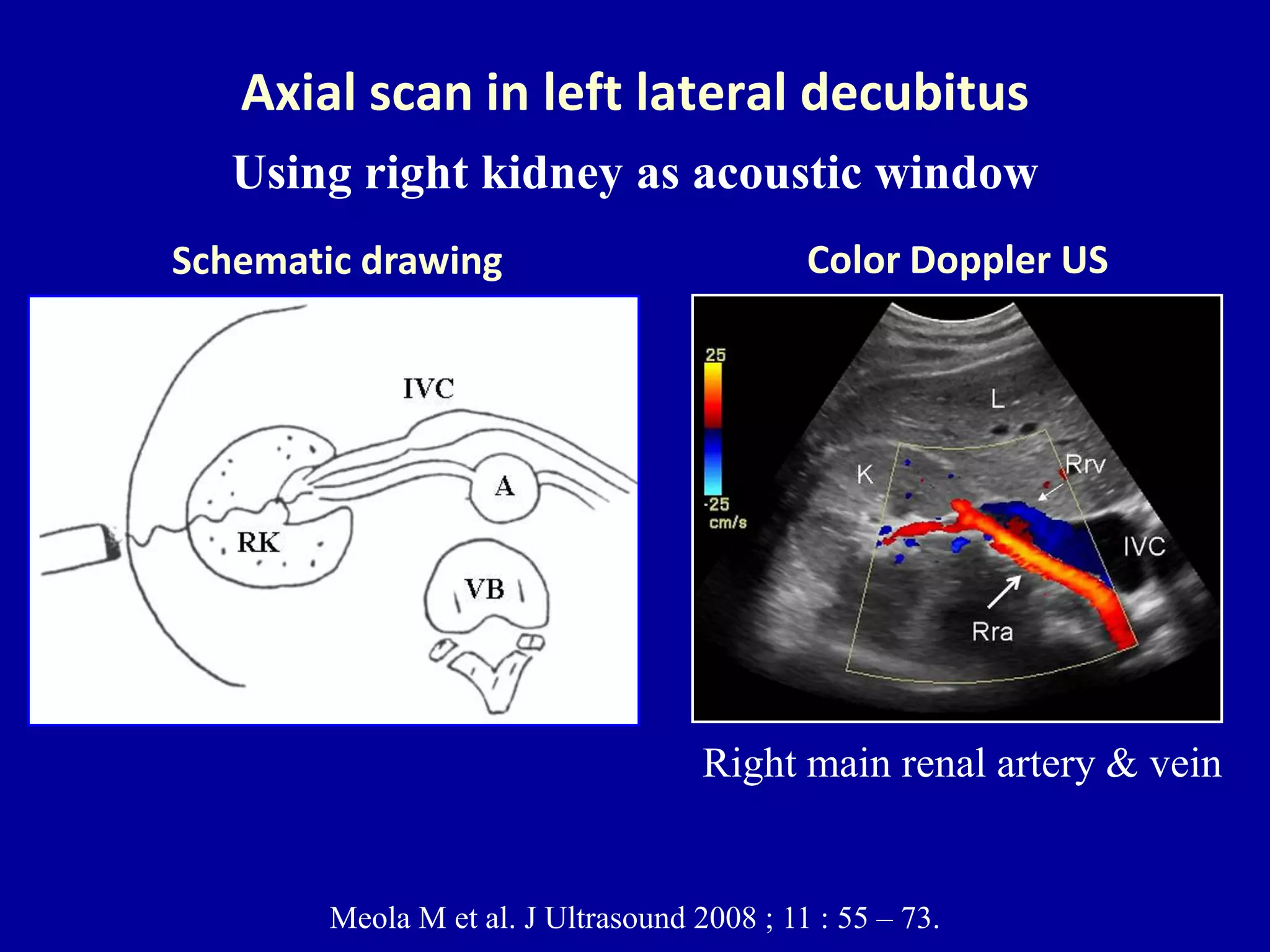 Doppler ultrasound of the kidneys | PPTX