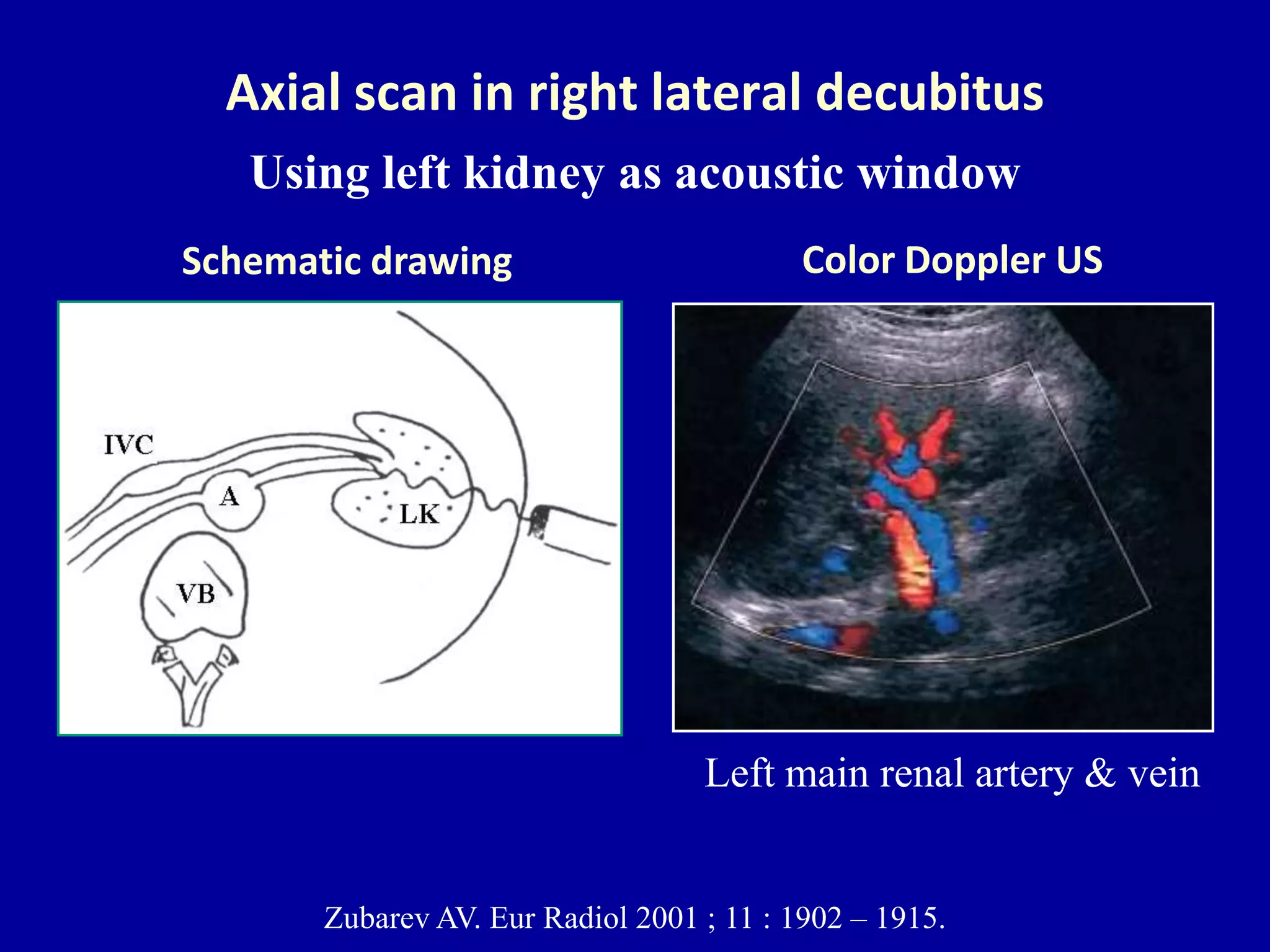Doppler ultrasound of the kidneys | PPTX