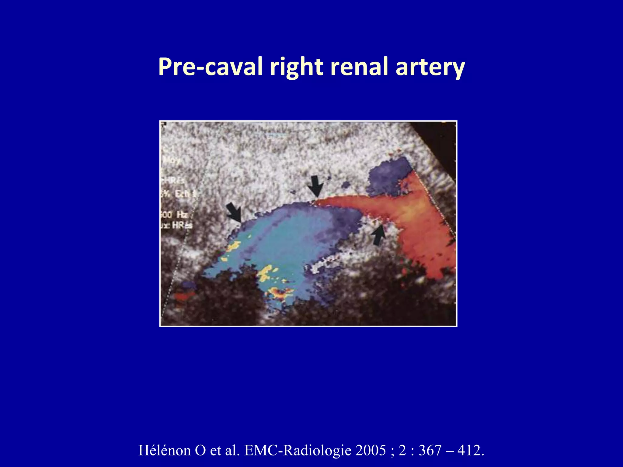 Doppler ultrasound of the kidneys | PPTX