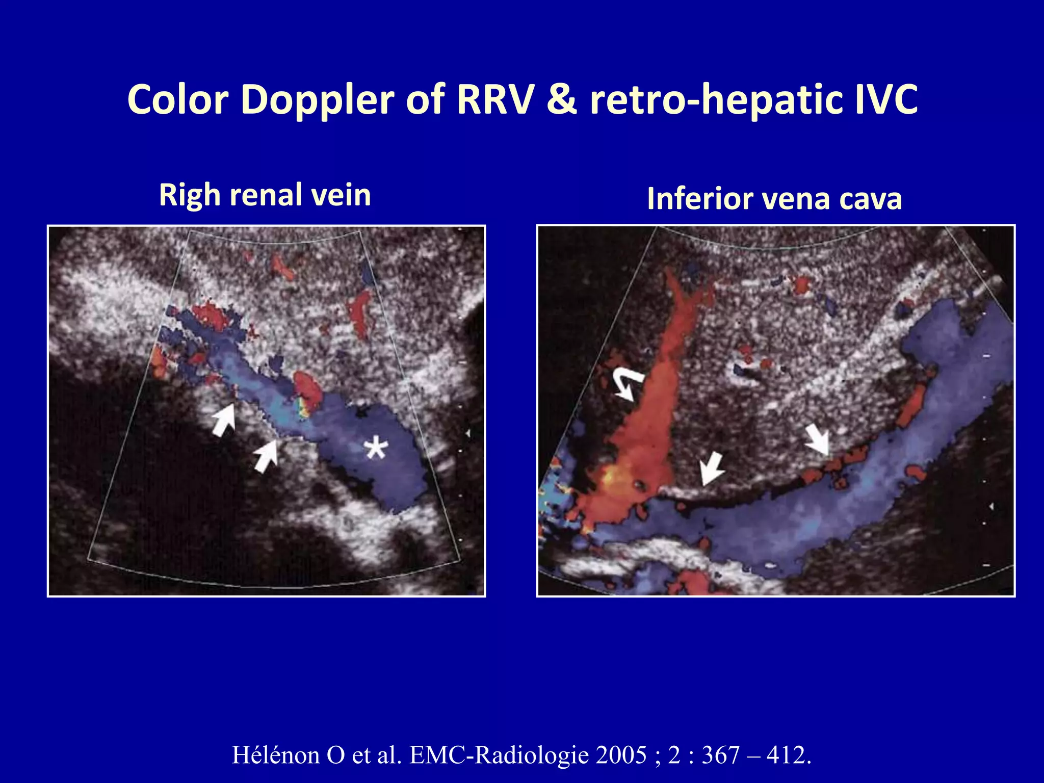 Doppler ultrasound of the kidneys | PPTX