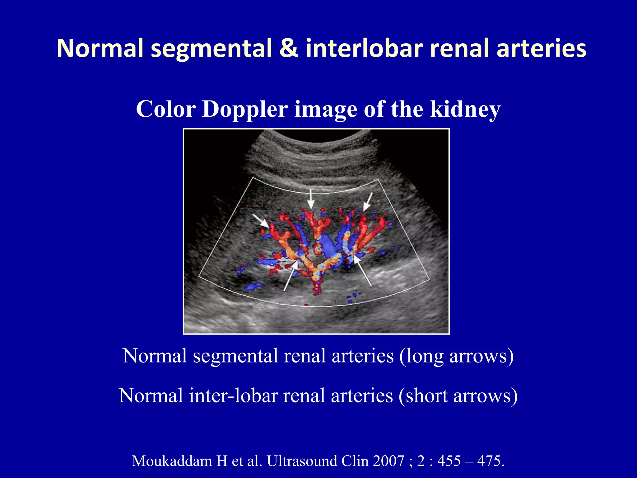 Doppler ultrasound of the kidneys | PPTX
