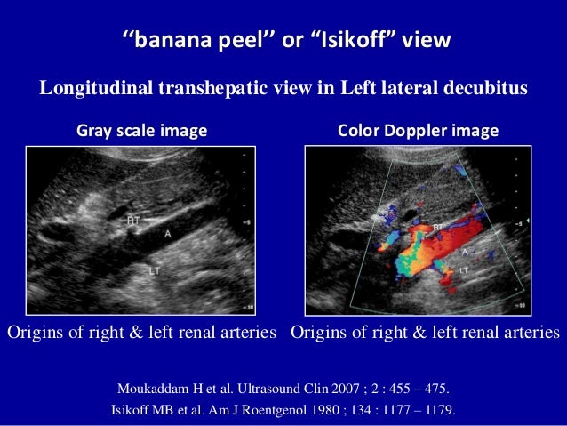Banana Sign Ultrasound