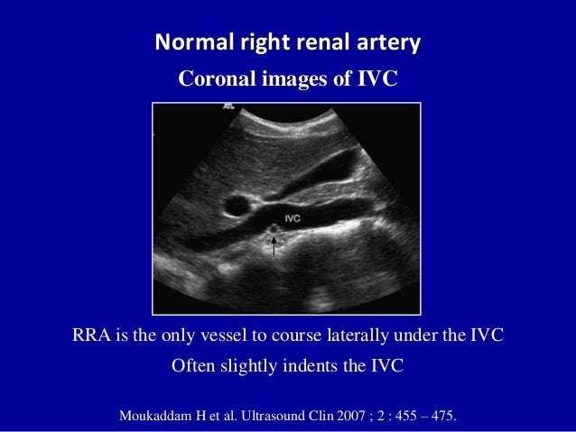 Doppler ultrasound of the kidneys