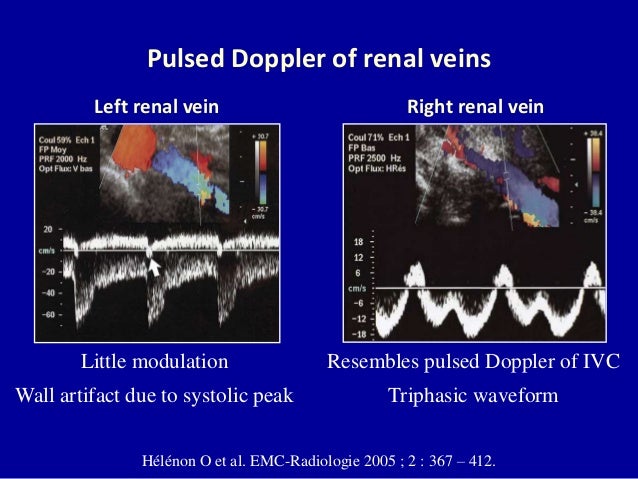 Doppler ultrasound of the kidneys