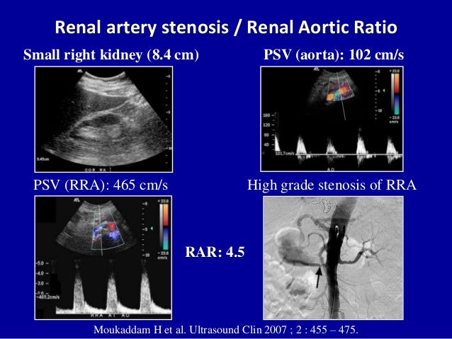 Doppler ultrasound of the kidneys
