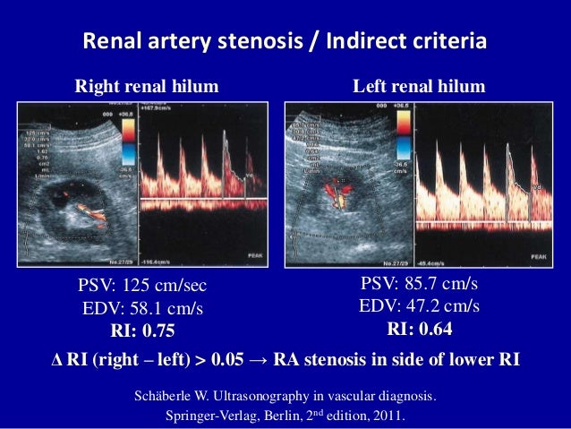 Doppler ultrasound of the kidneys