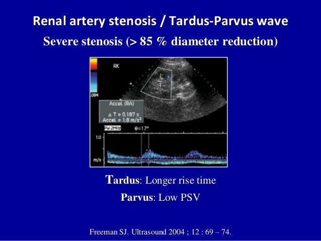Doppler ultrasound of the kidneys