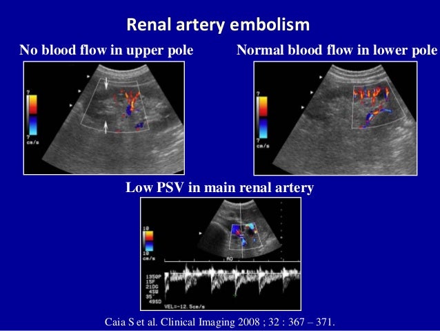Doppler ultrasound of the kidneys