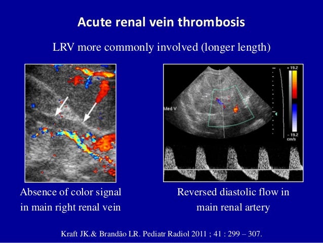 Doppler ultrasound of the kidneys