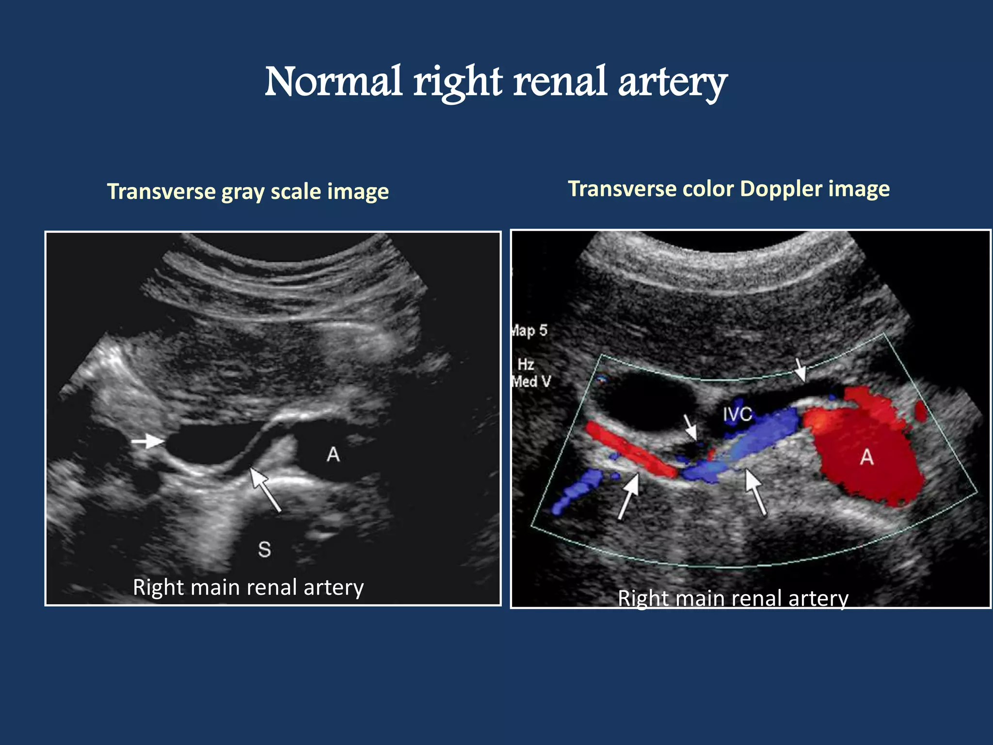 Doppler ultrasound of the Kidney | PPTX
