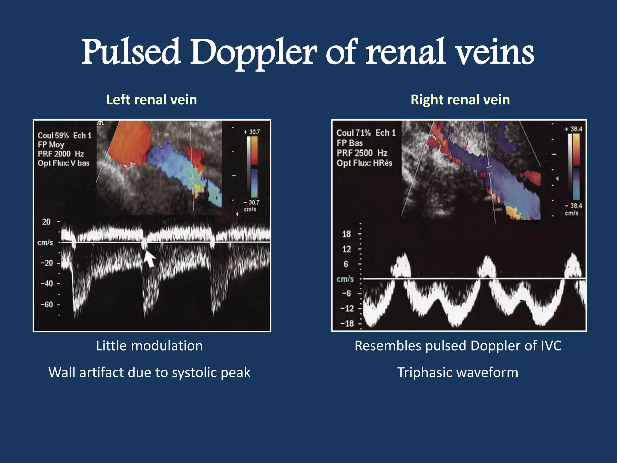Doppler ultrasound of the Kidney | PPTX