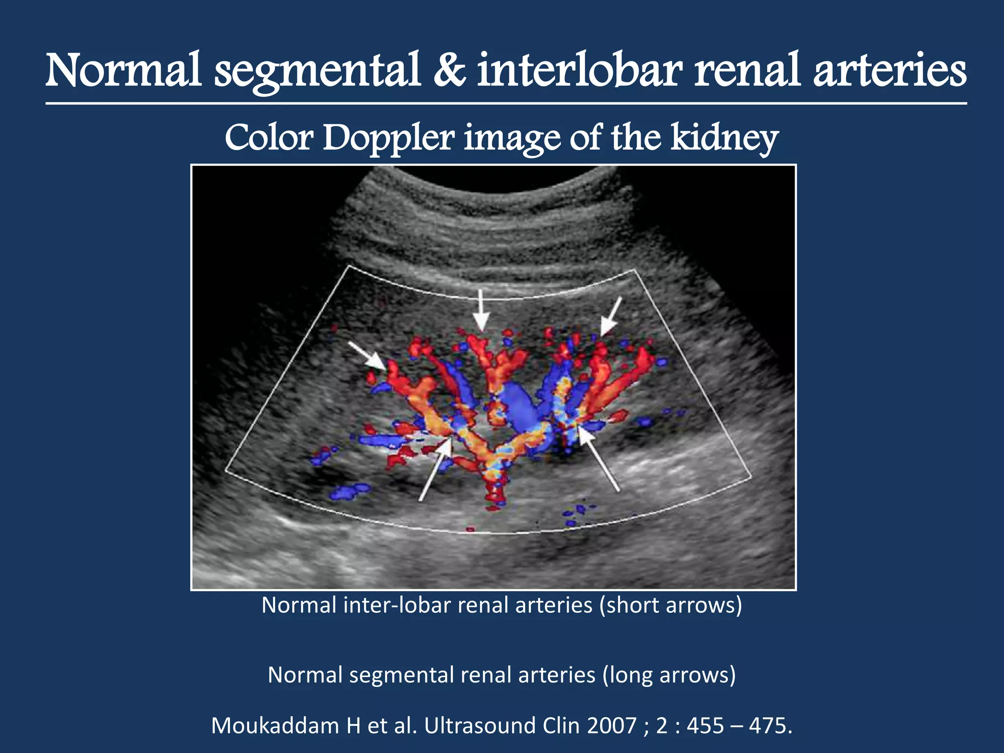 Doppler ultrasound of the Kidney | PPTX