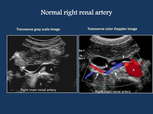 Doppler ultrasound of the Kidney | PPTX | Heart and Cardiovascular ...