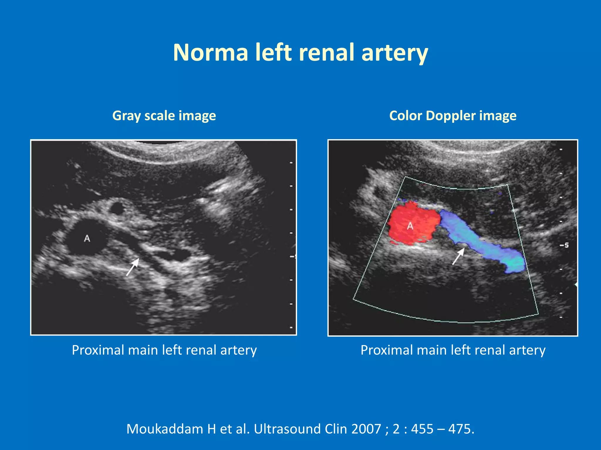 Doppler ultrasound of the kidneys 1 | PPTX