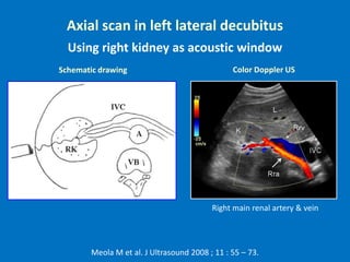 Doppler ultrasound of the kidneys 1 | PPTX